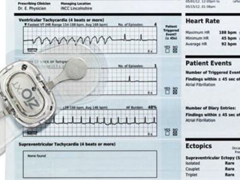 Study: Traditional Holter Monitor Outperformed by ZIO Service ...