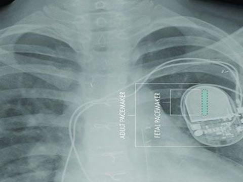 First Fully Implantable Micropacemaker for Foetal Use