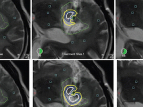 New MRI-Guided Laser Treatment for Brain Tumour