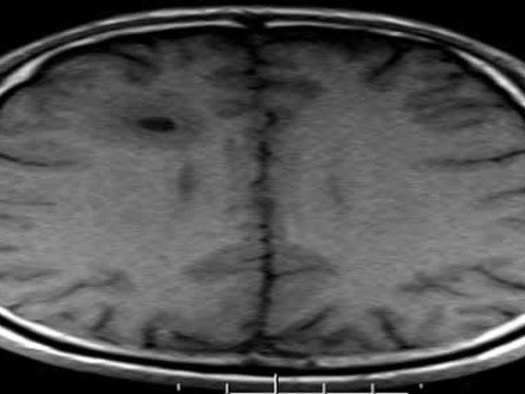 MRI May Detect Chronic Fatigue Syndrome