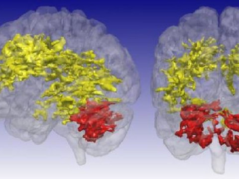 Bipolar Disorder: New MRI Method Provides New Insights