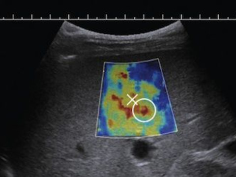New Aixplorer Ultrasound System Allows For Non-Invasive Liver Fibrosis ...