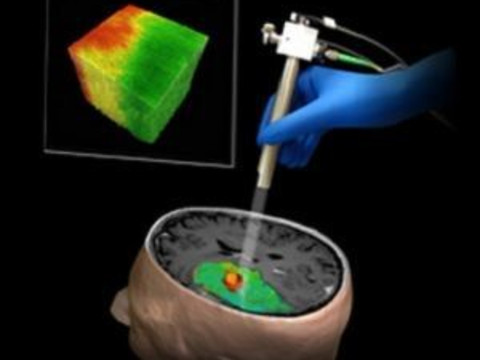 New Imaging Tool Could Make Brain Tumour Removal Safer