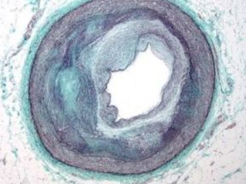 Diagnostic Imaging Can Rule Out CAD in Low-Risk Patients