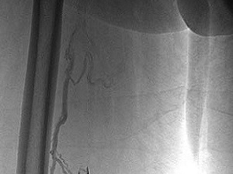 Canadian Guidelines on DVT Released