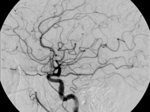 OCT Improves Post-PCI Outcome Compared to Angiography