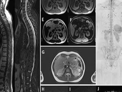 Study: whole body MRI is well-accepted by most patients