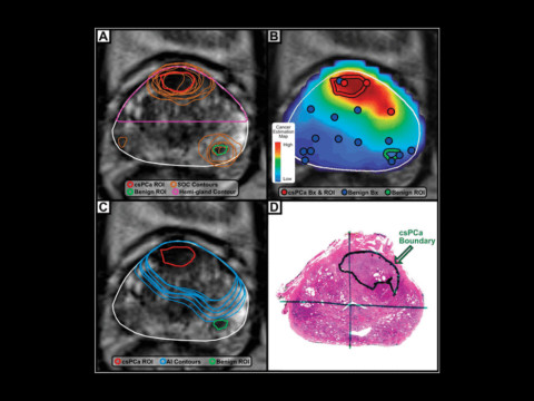 AI-Assisted Contouring in Prostate Cancer: Enhancing Accuracy ...