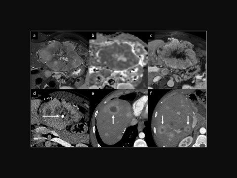 Understanding Peripheral Arterial Enhancement of Focal Liver Lesions