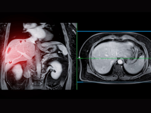 Advancing HCC Diagnosis with Combined Imaging