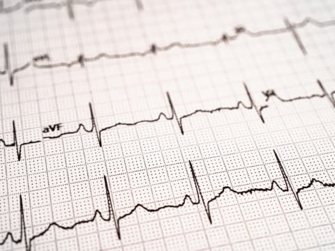 AI-Powered ECGs for Early Heart Failure Risk