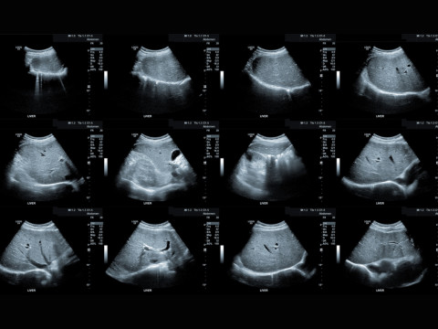 Enabling AI-Driven Ultrasound at the Point of Care