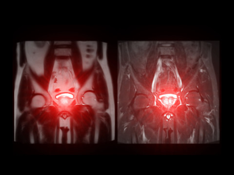 Faster Prostate MRI with Improved Image Quality