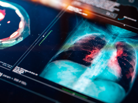 France Launches Pilot for Equitable Lung Cancer Screening