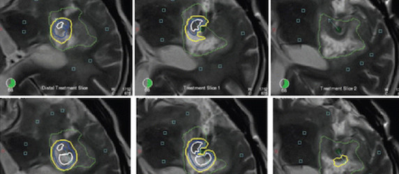 New MRI-Guided Laser Treatment for Brain Tumour - HealthManagement.org