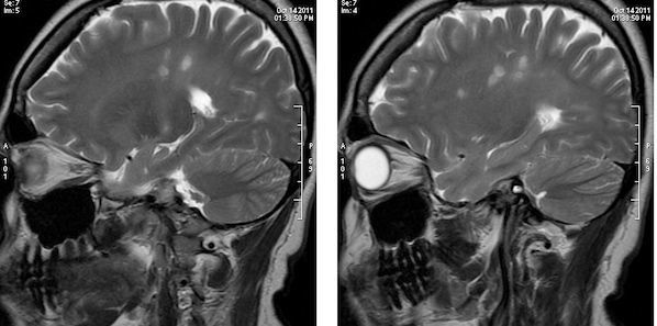 MRI Shows Grey Matter Demyelination in MS - HealthManagement.org
