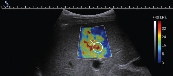 FibroScan® Gains FDA Approval for Non-Invasive Liver Diagnosis - HealthManagement.org