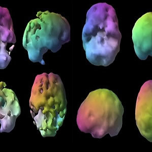 SPECT Imaging Helps Distinguish Depression from Dementia ...