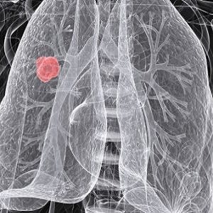 Lung-RADS: Potential Drawbacks and Need for Revision - HealthManagement.org