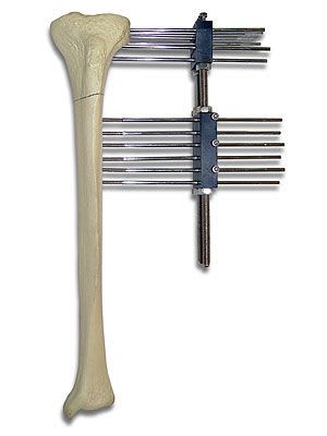 Health Management and Leadership Portal | Human external fixation ...