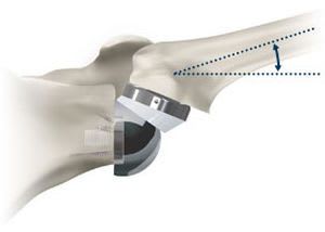 Health Management and Leadership Portal | Inverted total shoulder ...
